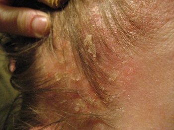 Dandruff Information ~ Best Hair Products