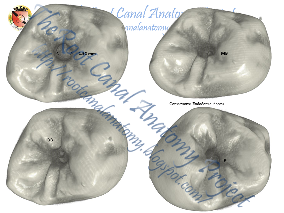 The Root Canal Anatomy Project: Conservative Endodontic Access ...