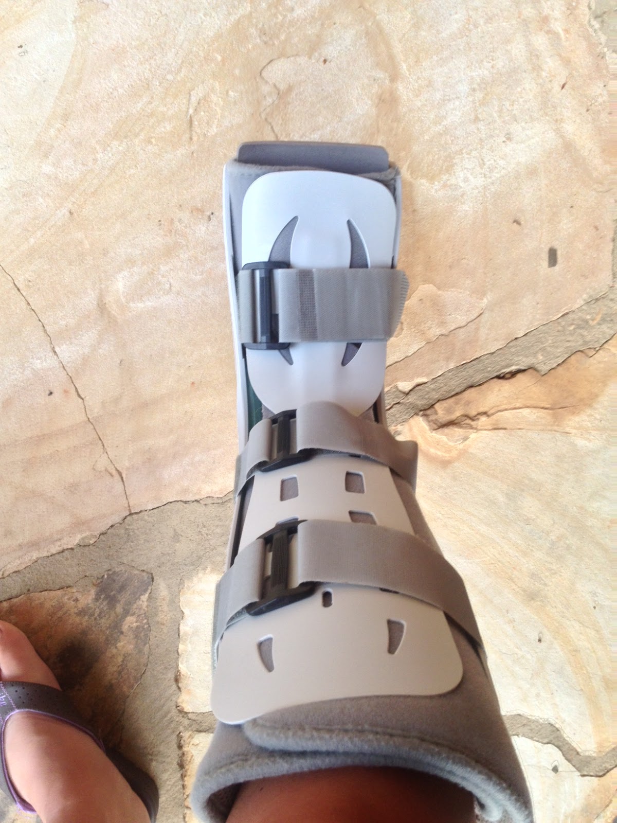 The surgical recovery of and surviving a fully ruptured peroneal long ...