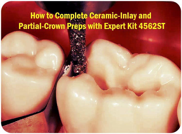 DENTAL MATERIALS: How to Complete Ceramic-Inlay and Partial-Crown Preps ...
