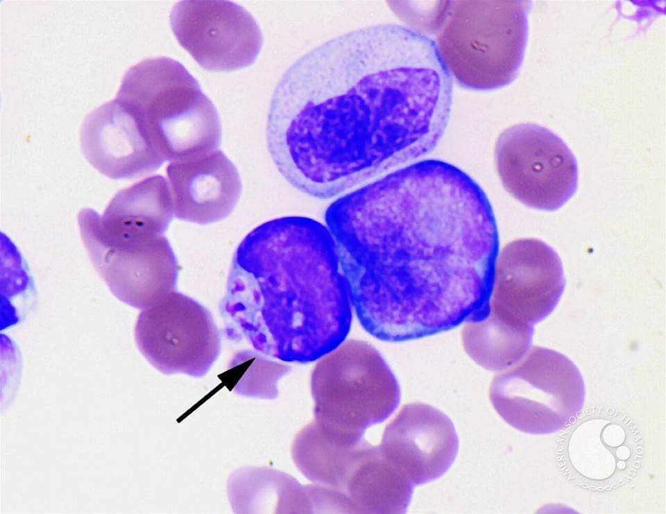 Pseudo Chediak-Higashi Granules