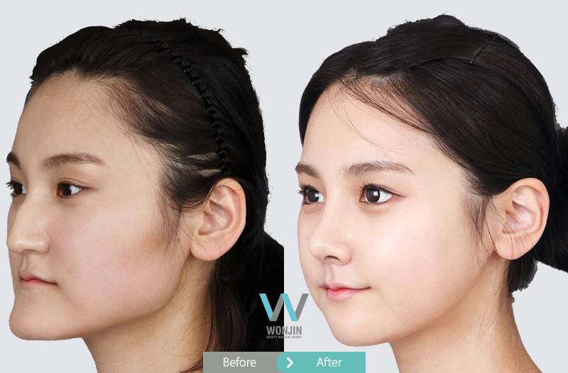 Mulut yang Maju dapat Diperbaiki dan Diobati dengan Operasi Dua Rahang