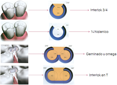 Microfresado Dental: INTERLOCKS