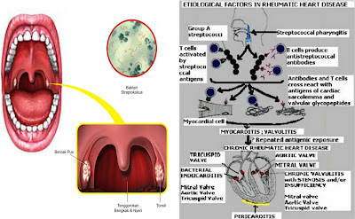 HealthVision [ LIFESTYLE ]: DEMAM REMATIK