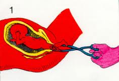 El aborto: TIPOS DE ABORTO