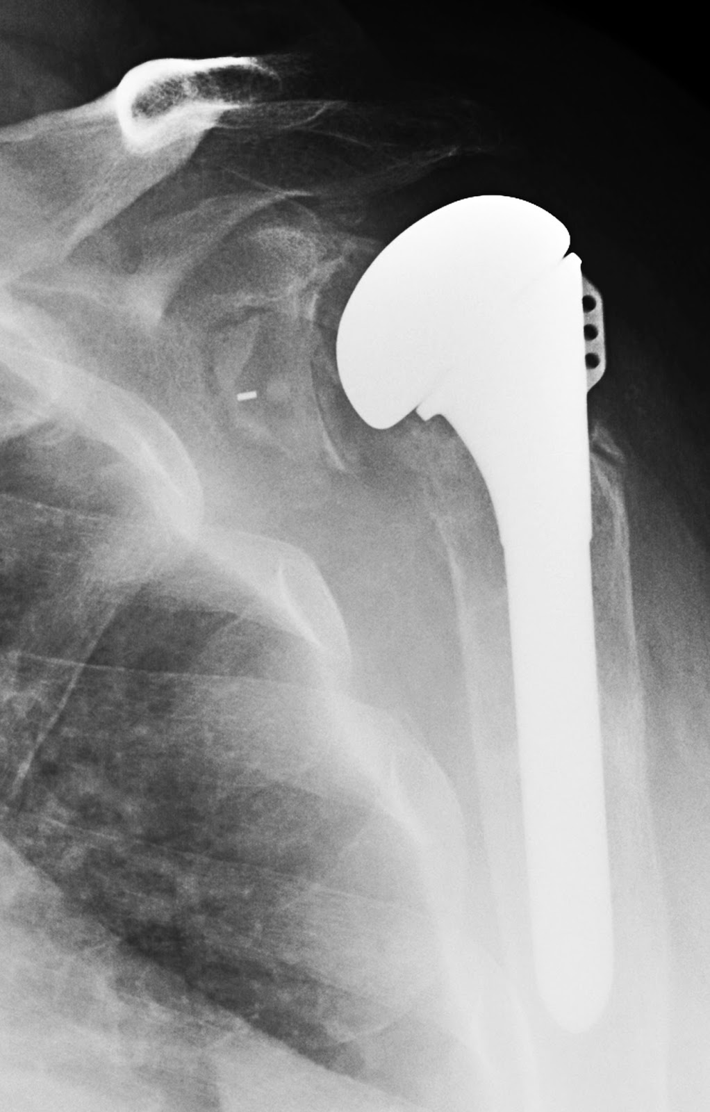 UW Shoulder and Elbow Academy: Shoulder joint replacement - selecting ...