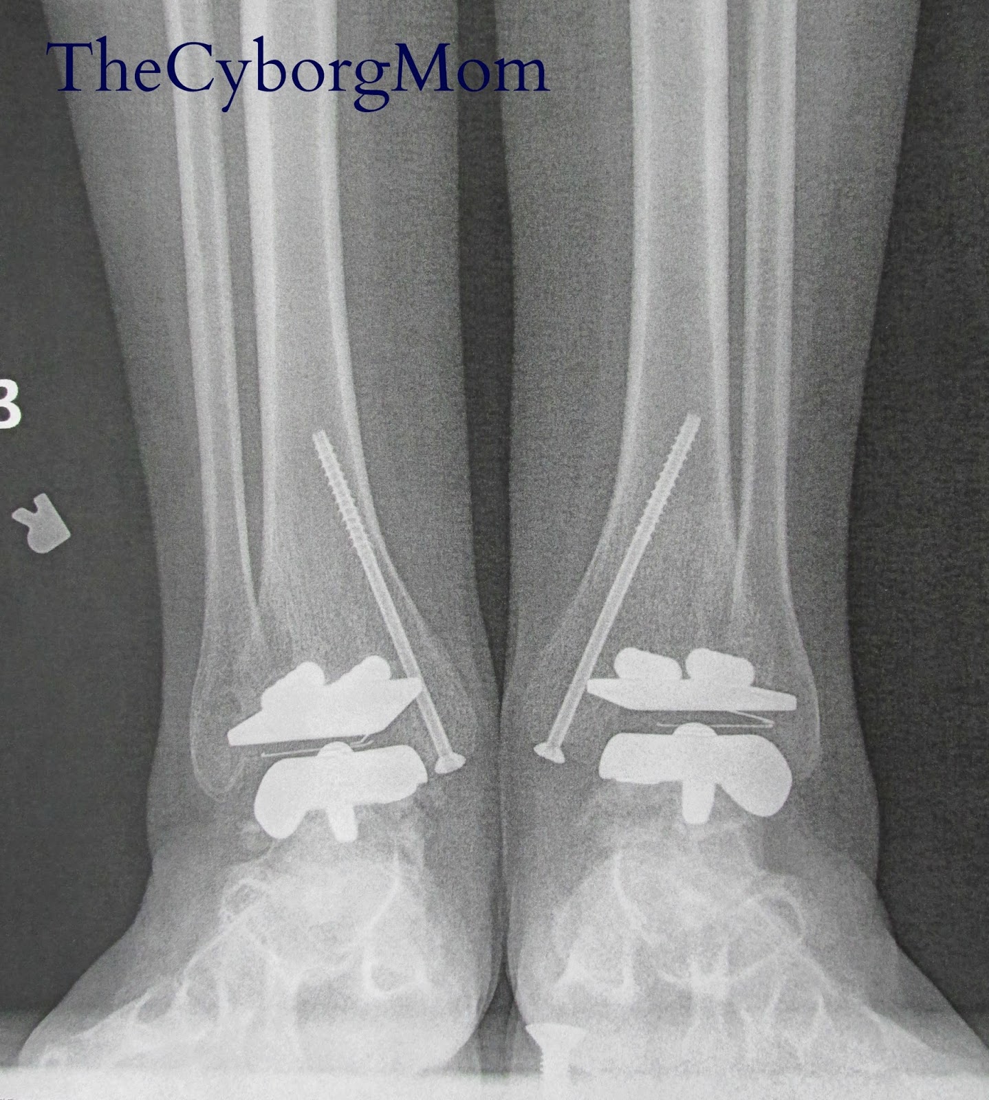 TheCyborgMom: TAR Pics/X-Rays