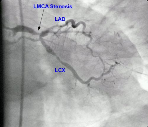 Left Main Coronary Artery Stenosis | INA - ECG