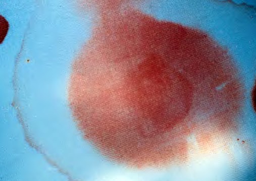 CSF rhinorrhea - Double-ring sign / ring sign / halo sign ~ Medicine Hack