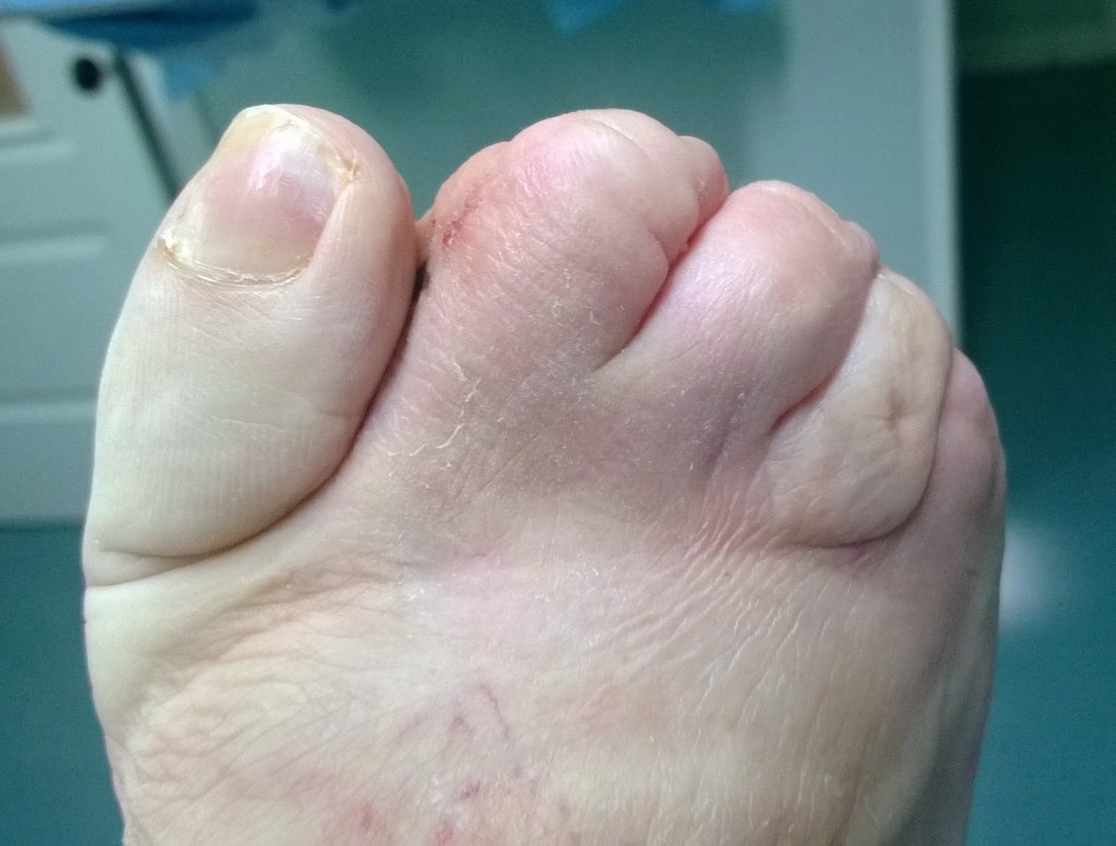 ARS PODOLOGIA: Artritis Reumatoide Y Antecedentes Quirúrgicos como ...