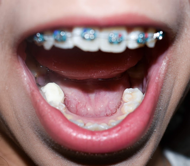 My Braces Journey: Part III (Pasang Behel di FDC - Sebulan Bersama ...