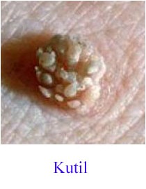 Jenis Penyakit Kulit Lengkap dengan Gambar dan Pengobatannya ...