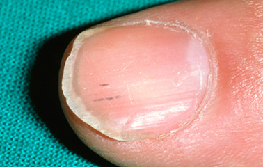 Nail bed abnormalities - Awesome Nail