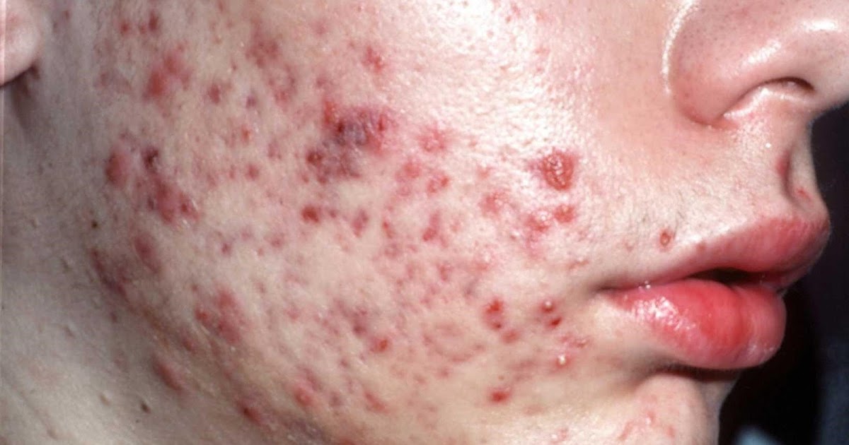 Health all Tips: What is Acne?