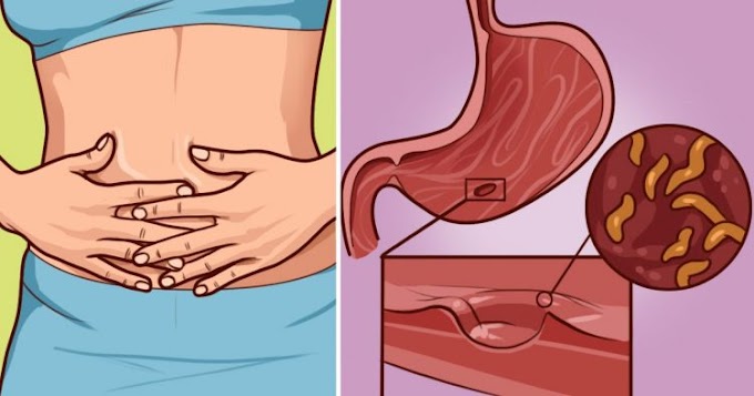 Você sabia que a úlcera é causada por bacterias? Conheça o remédio ...