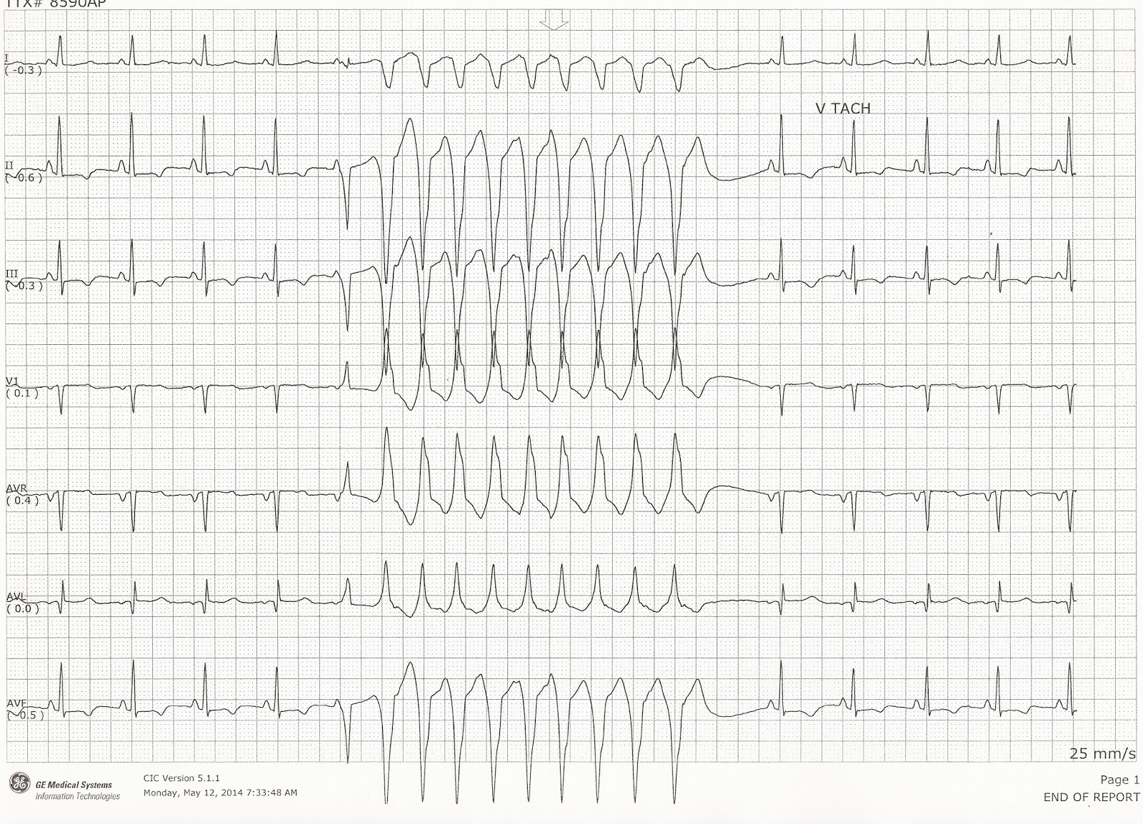 Sinus rhythm with a run of ventricular tachycardia