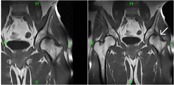 Femoro-Acetabular Impingement-MRI - Sumer's Radiology Blog