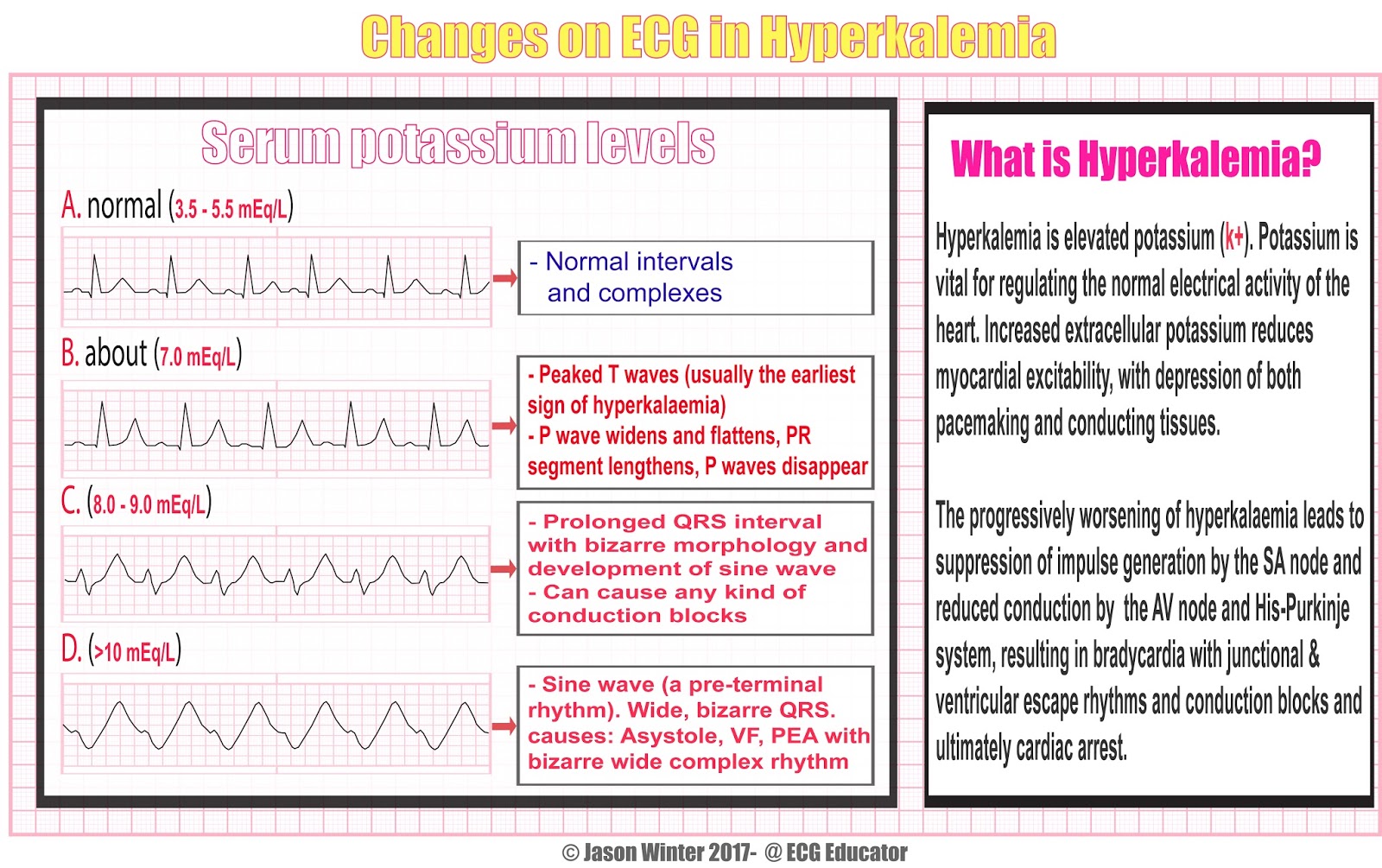 ECG Educator Blog : Hyperkaelemia ECG Features