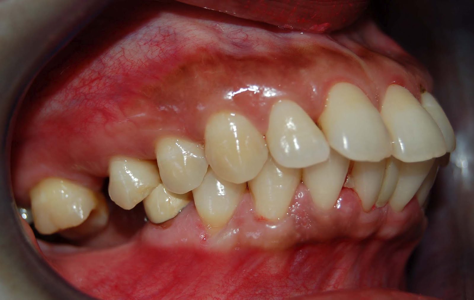 aryabrahmanta: MINI SCREW AS TEMPORARY ANCHORAGE DEVICES IN BIMAXILLARY ...