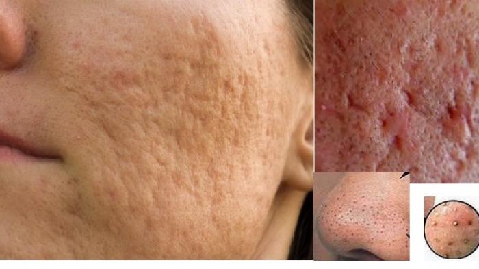 Cara Mengatasi Pori-Pori Wajah Besar dan Mencegah dengan Alami