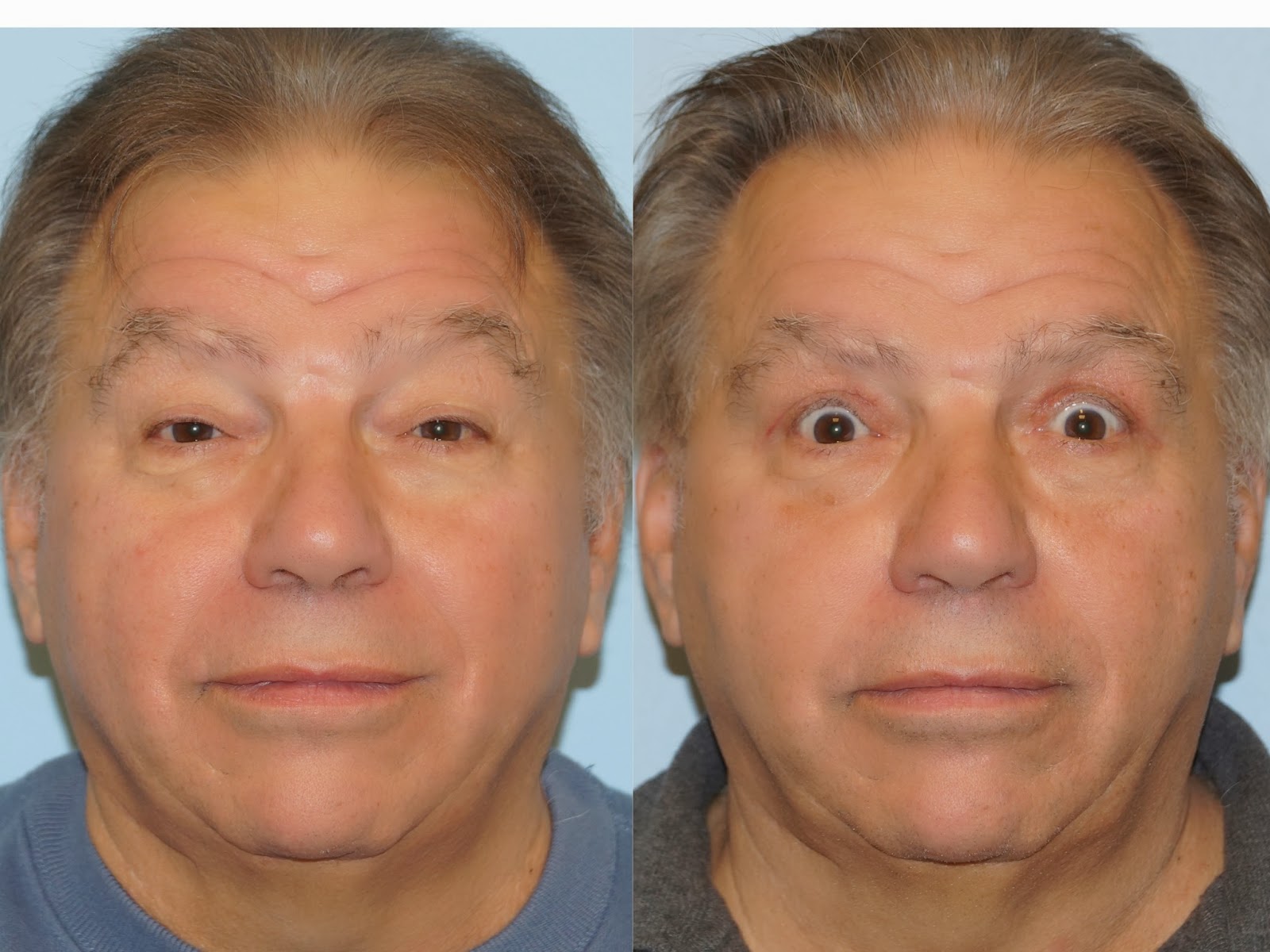Facial Plastic Surgery Lazy Eye Ptosis Repair Upper Blepharoplasty facial-plastic-surgery-lazy-eye-ptosis-repair-upper-blepharoplasty