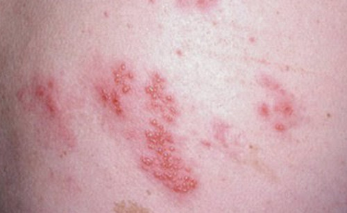 Pictures of HIV Rash | Medical Pictures and Images - (2023 Updated)