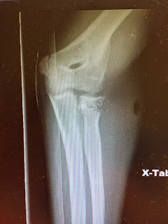 Shoulder and Elbow Surgery: "A Bullet in the radial head"