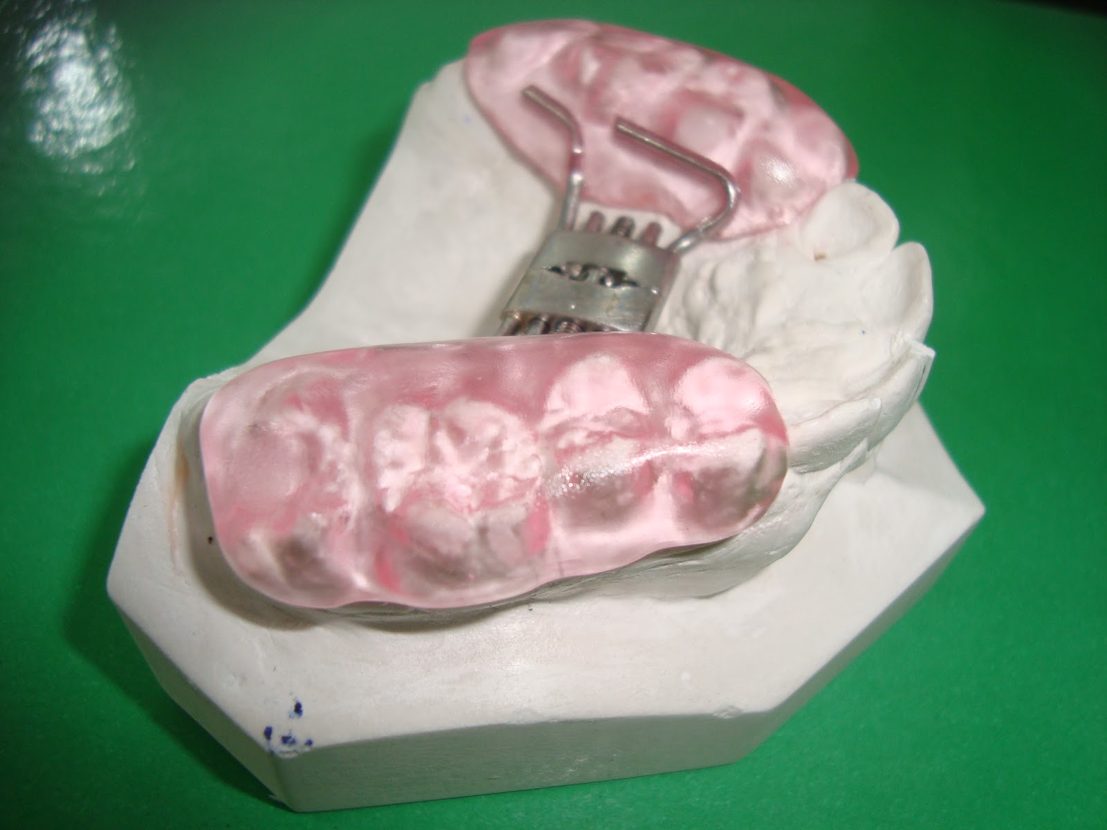 Laboratório Ortodôntico Bohrer: APARELHO DE MACNAMARA COM EXP.HIRAX