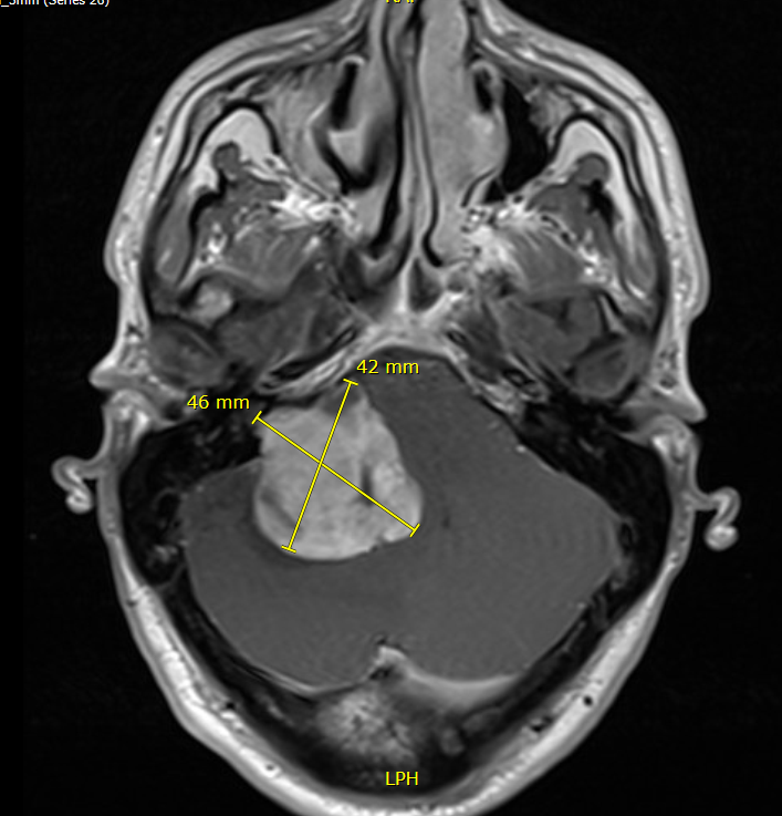 Neurophysiology Plus Iceland: Cerebellopontine angle (CPA) mass IONM