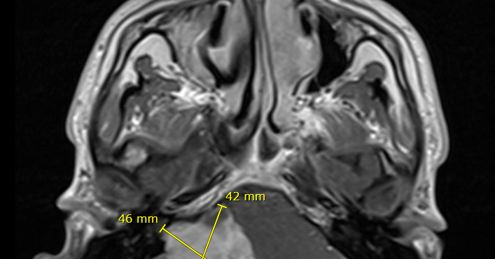 Neurophysiology Plus Iceland: Cerebellopontine angle (CPA) mass IONM