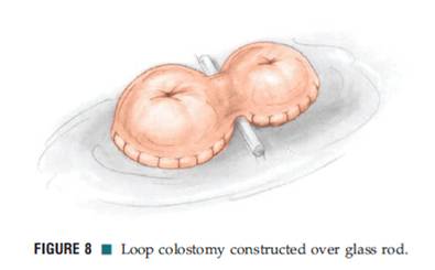 Sudiyatmo,MD Blog & Journal: INTESTINAL STOMA