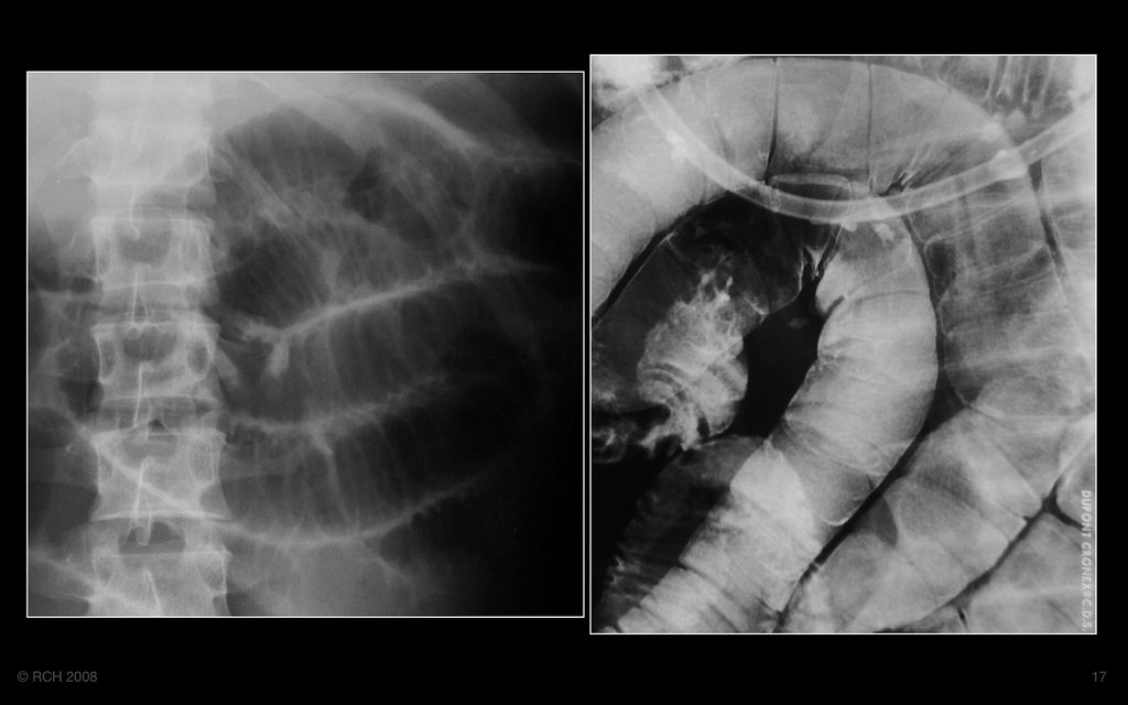 Hello USA: enteroclysis