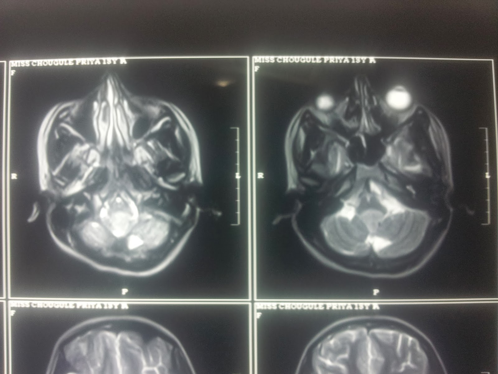 Dr Balaji Anvekar FRCR: Spinal Drop Metastasis from Choroid Plexus ...