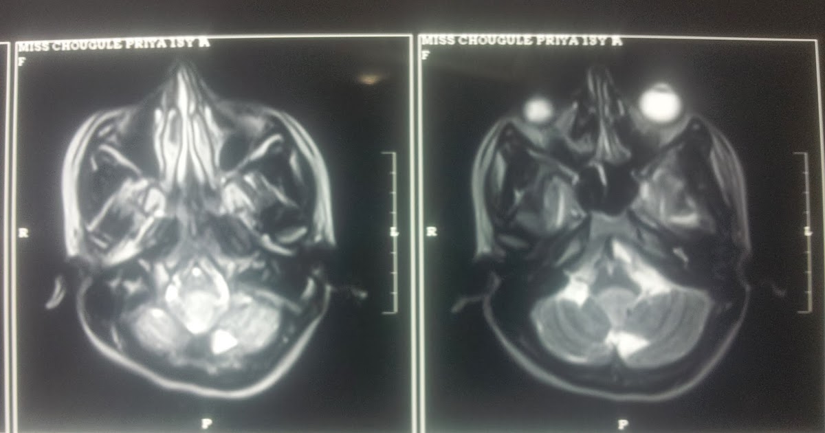 Neuroradiology Cases: Spinal Drop Metastasis from Choroid Plexus ...