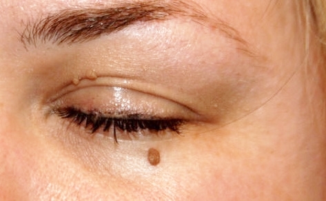 markbuttons: Facial mole removal Dermatend Cream