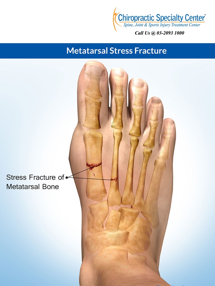 Foot Pain Metatarsal Joint at Margaret Newsom blog