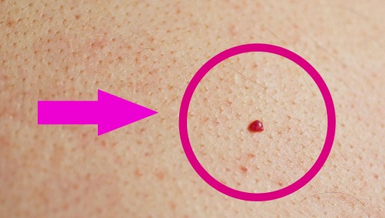 Casos de Salud: ¿Son cancerosos los lunares rojos?