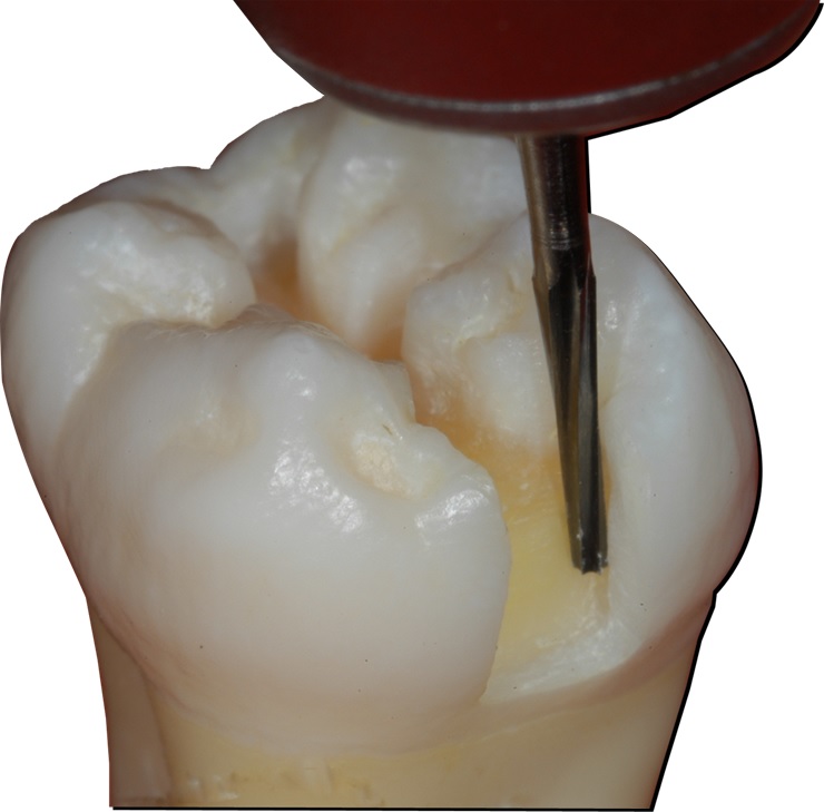 Saúde da Boca: Preparo Cavitários- CAVIDADES CLASSE I e II PARA AMÁLGAMA