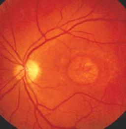 Gulans tankar: Fundus flavimaculatus