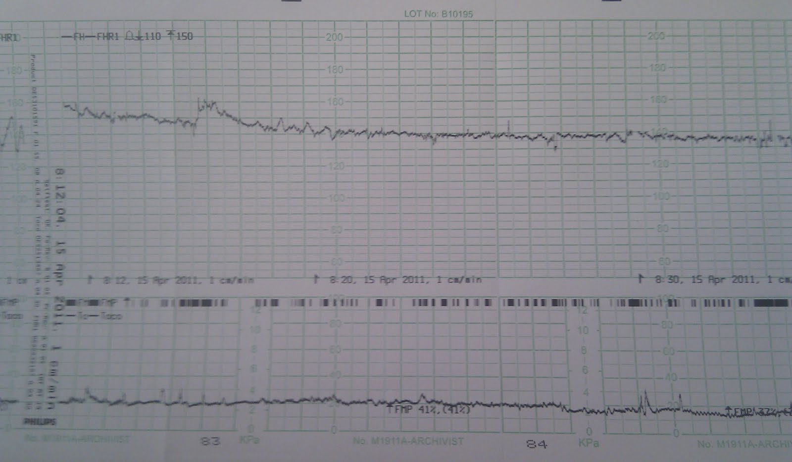 The Pitter Patter of Tiny Feet: Braxton Hicks or Preterm Labour!?