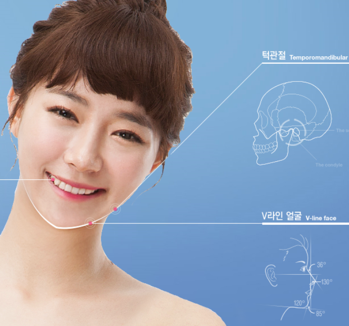 ID Hospital Korea: Orthognathic Surgery at ID Hospital for underbites ...