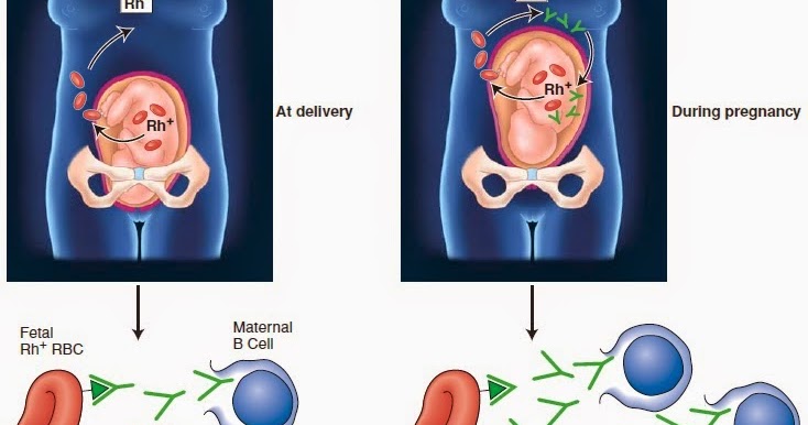 Quike & Vivi's World: Erythroblastosis Fetalis
