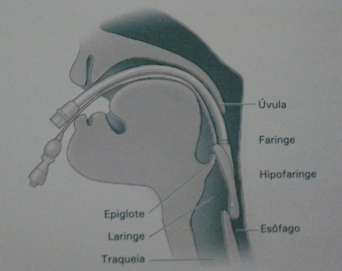 Enfermagem Superintensiva : Obtenção de via aérea avançada