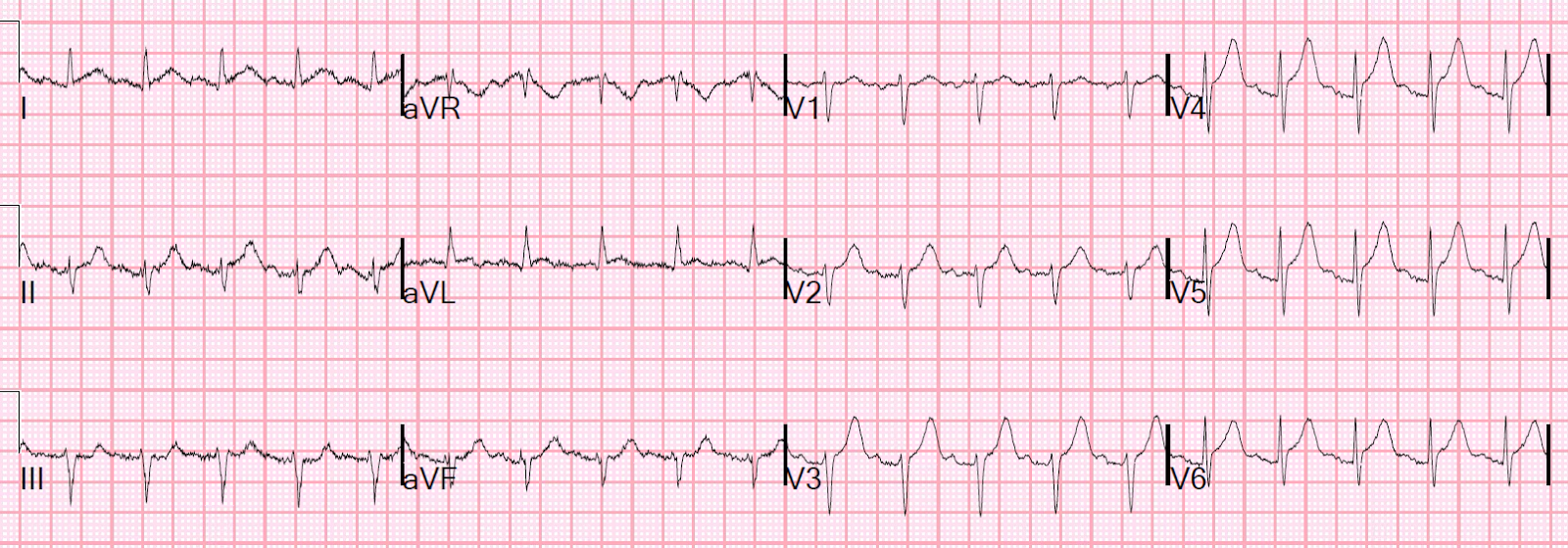 Sinus Tachycardia