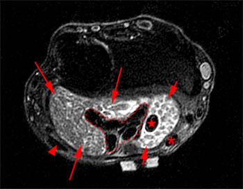 MRI Musculo-Skeletal Section: Classic horseshoe abscess.