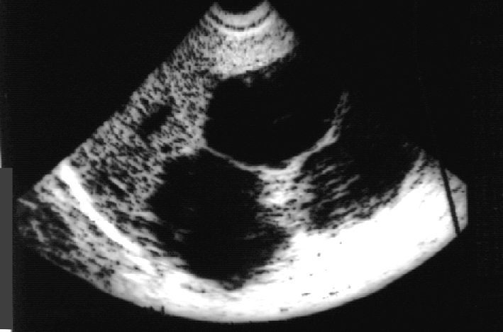 ecografie imagini medicina renal Renal nativ Hidronefroza | Terapii ...