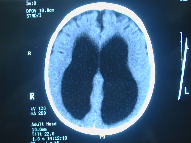 Dr. Nate Selden: Magnets and Shunt Valves