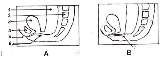 Dr Herry Setya Yudha Utama SpB. FInaCS. MHKes. ICS: ATRESIA ANI ...