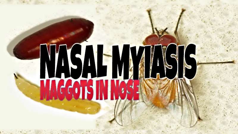 MBBS DOCTORS: Nasal Myiasis: Maggots in Nose