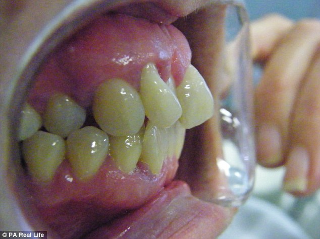 This 49-Year-Old Woman Had A Rare Gum Disease That Turned Her Teeth ...
